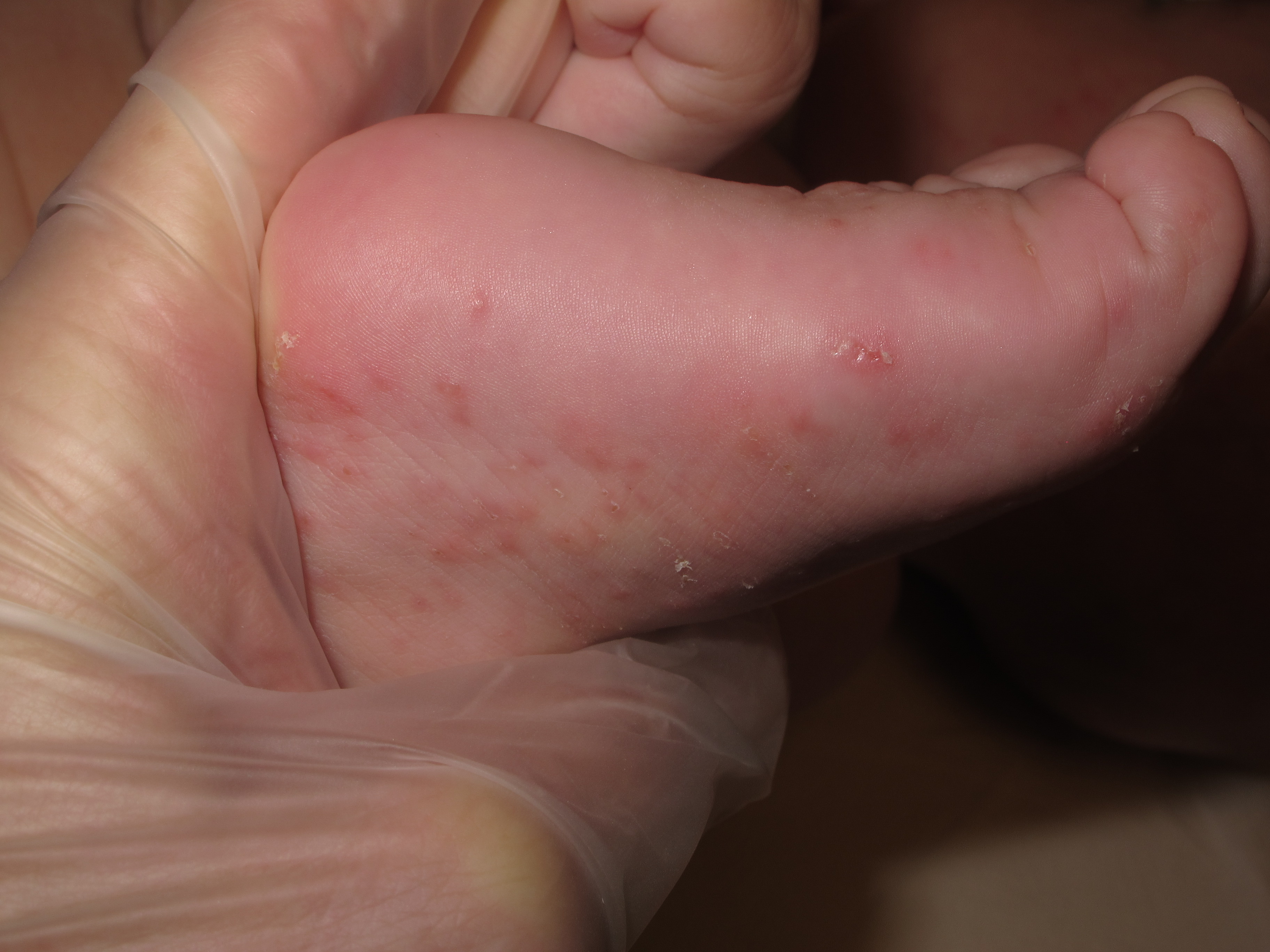 Sarna o escabiosis | Escola Salut SJD